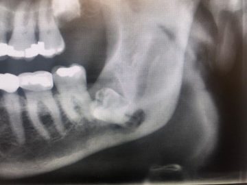 Wisdom Tooth Extraction and Diving - Divers Alert Network