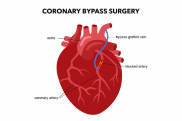 Coronary Artery Bypass Grafts - Divers Alert Network